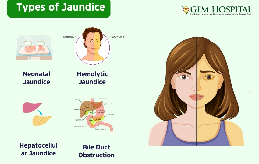 Best Doctors for Jaundice in Coimbatore | GEM Hospitals